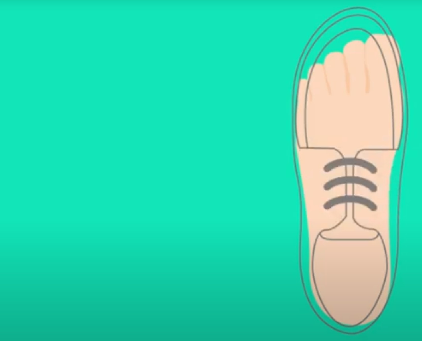 Plantar Fasciopathy - Keeping Me Well