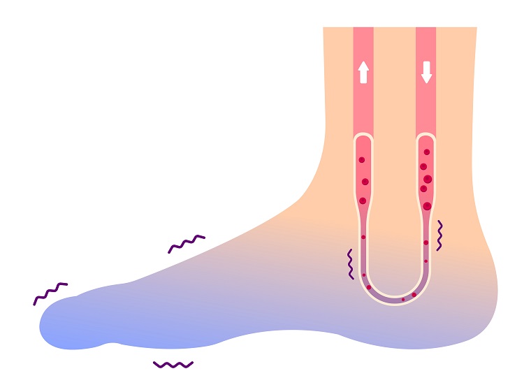 Peripheral Arterial Disease (PAD) - Keeping Me Well