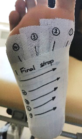 Plantar Fasciopathy - Keeping Me Well