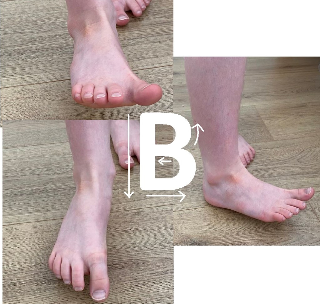 Leg Fractures - Keeping Me Well