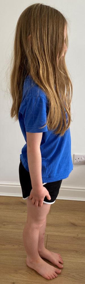 Arm Fracture - Keeping Me Well